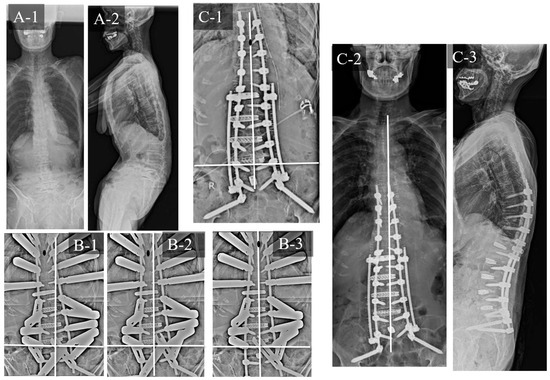 New Effective Intraoperative Techniques for the Prevention of Coronal ...