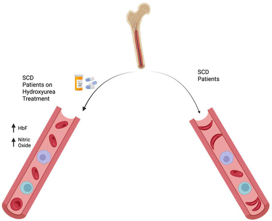 Hope on the Horizon: New and Future Therapies for Sickle Cell Disease