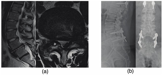 Jcm Free Full Text Posterior Decompression And Fixation For