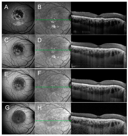 Acute-Onset Retinal Conditions Mimicking Acute Optic Neuritis: Overview ...