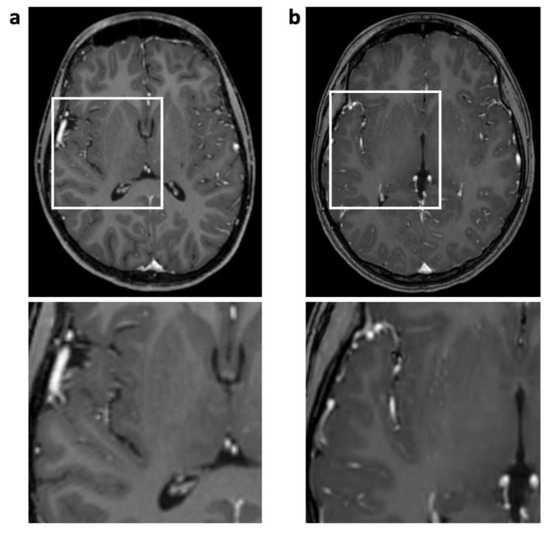 Evaluation of Artifact Appearance and Burden in Pediatric Brain Tumor MR Imaging with Compressed ...