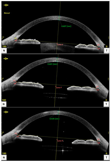 Descemet Membrane Endothelial Keratoplasty and Descemet Stripping Only ...