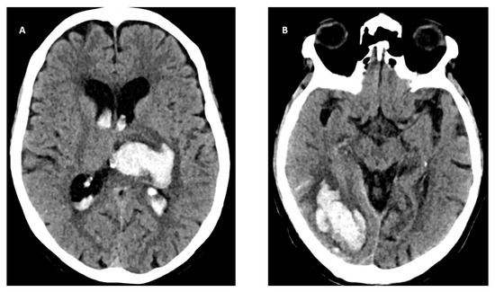 Management and Prognosis of Acute Stroke in Atrial Fibrillation