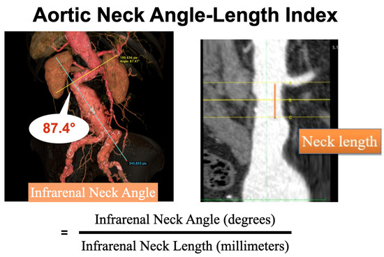 The Correlation of Aortic Neck Angle and Length in Abdominal Aortic ...