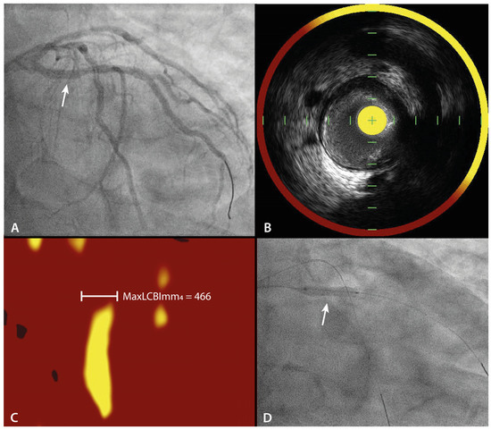 First-in-Human Drug-Eluting Balloon Treatment of Vulnerable Lipid-Rich ...