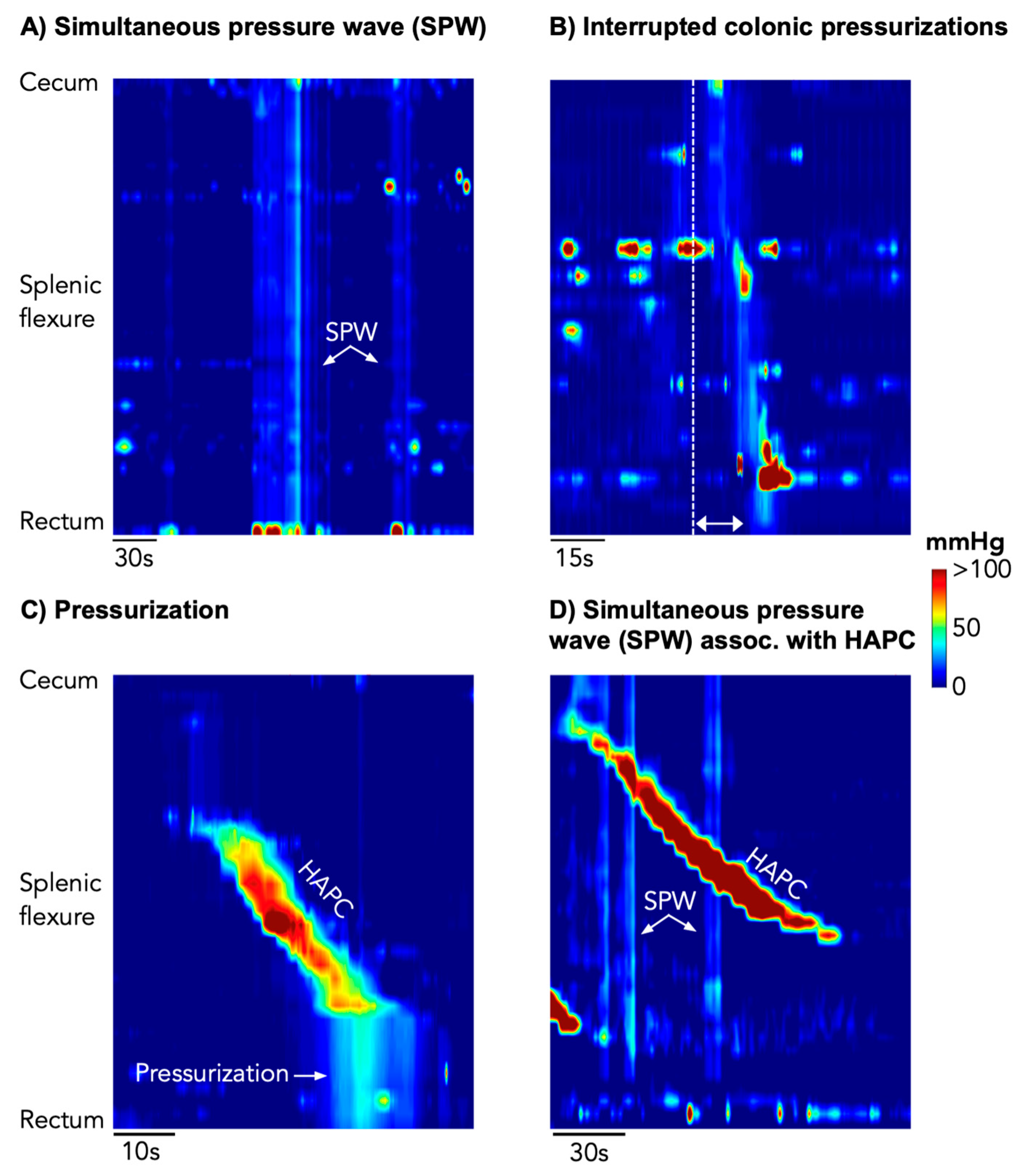 Simultaneous Colonic Pressure Waves in Children and Young Adults with ...