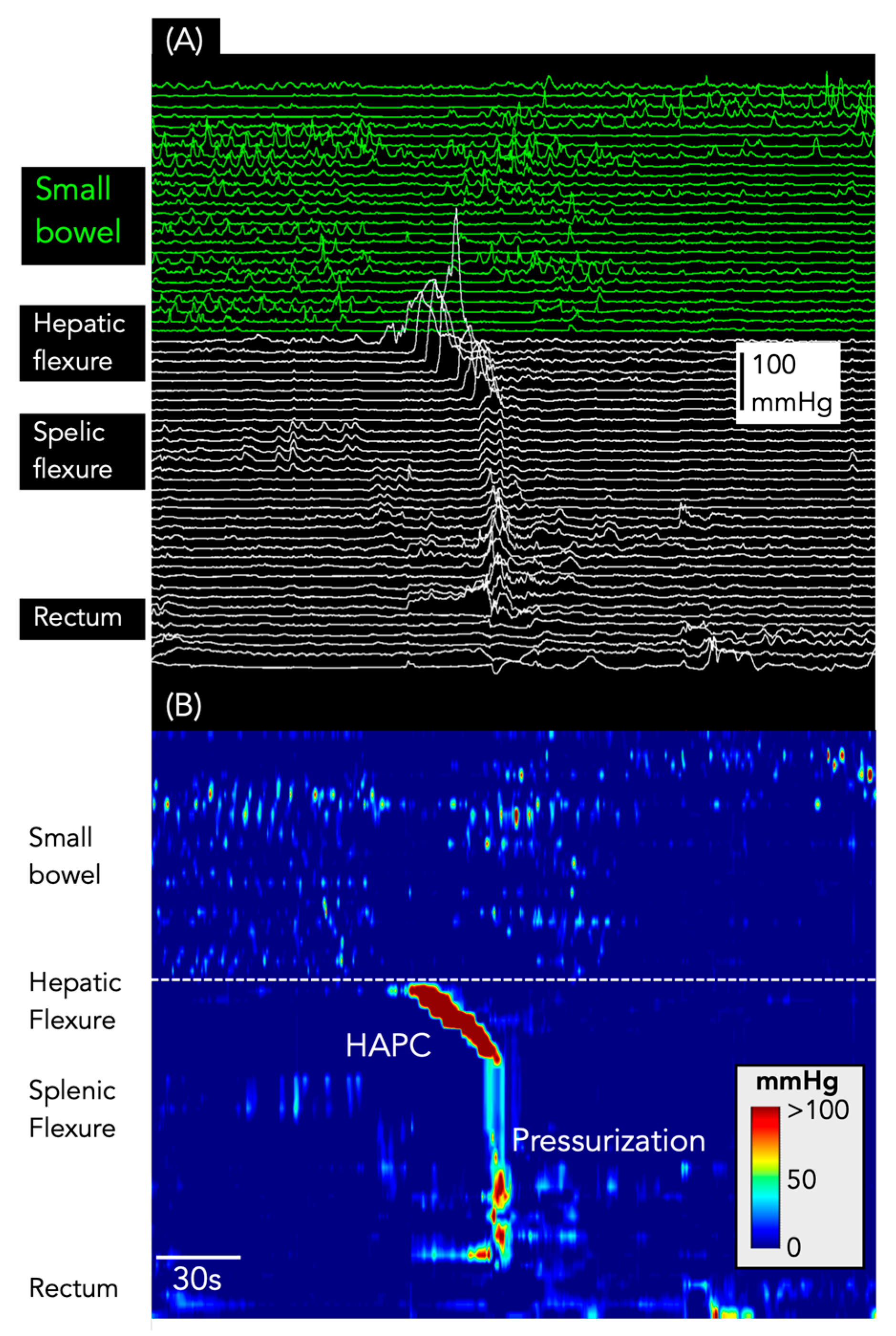 JCM | Free Full-Text | Simultaneous Colonic Pressure Waves in Children ...