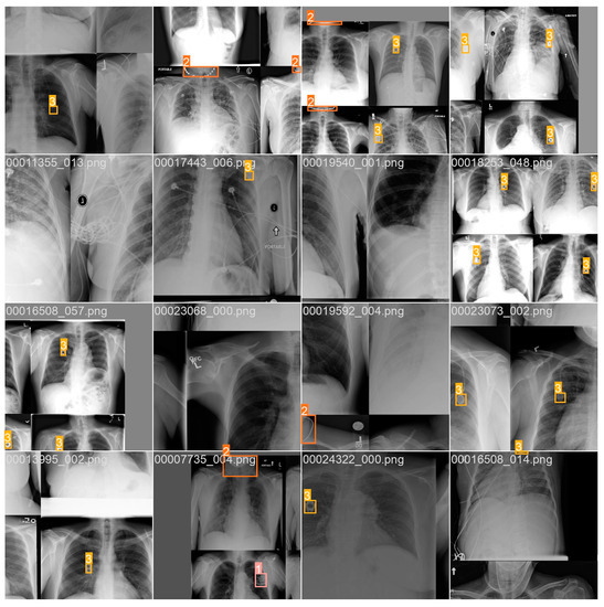 Chest X-ray Foreign Objects Detection Using Artificial Intelligence