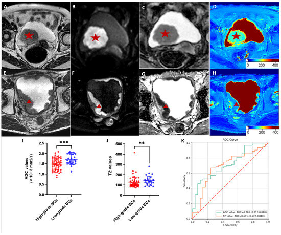 Radiomic Analysis of Quantitative T2 Mapping and Conventional MRI in ...