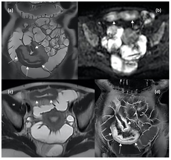 Predicting Treatment Response in Inflammatory Bowel Diseases: Cross ...