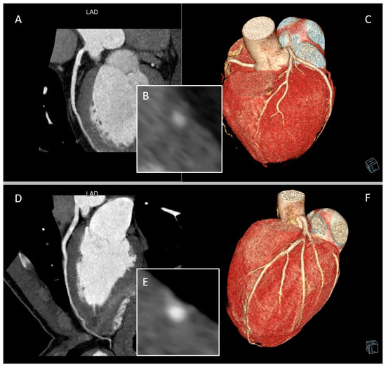 Myocardial Bridging: Review on the Role of Coronary Computed Tomography ...
