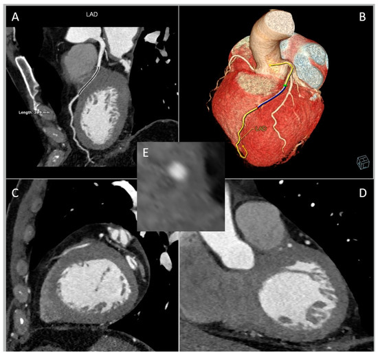 JCM | Free Full-Text | Myocardial Bridging: Review on the Role of ...