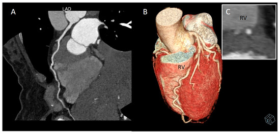 Myocardial Bridging: Review on the Role of Coronary Computed Tomography ...