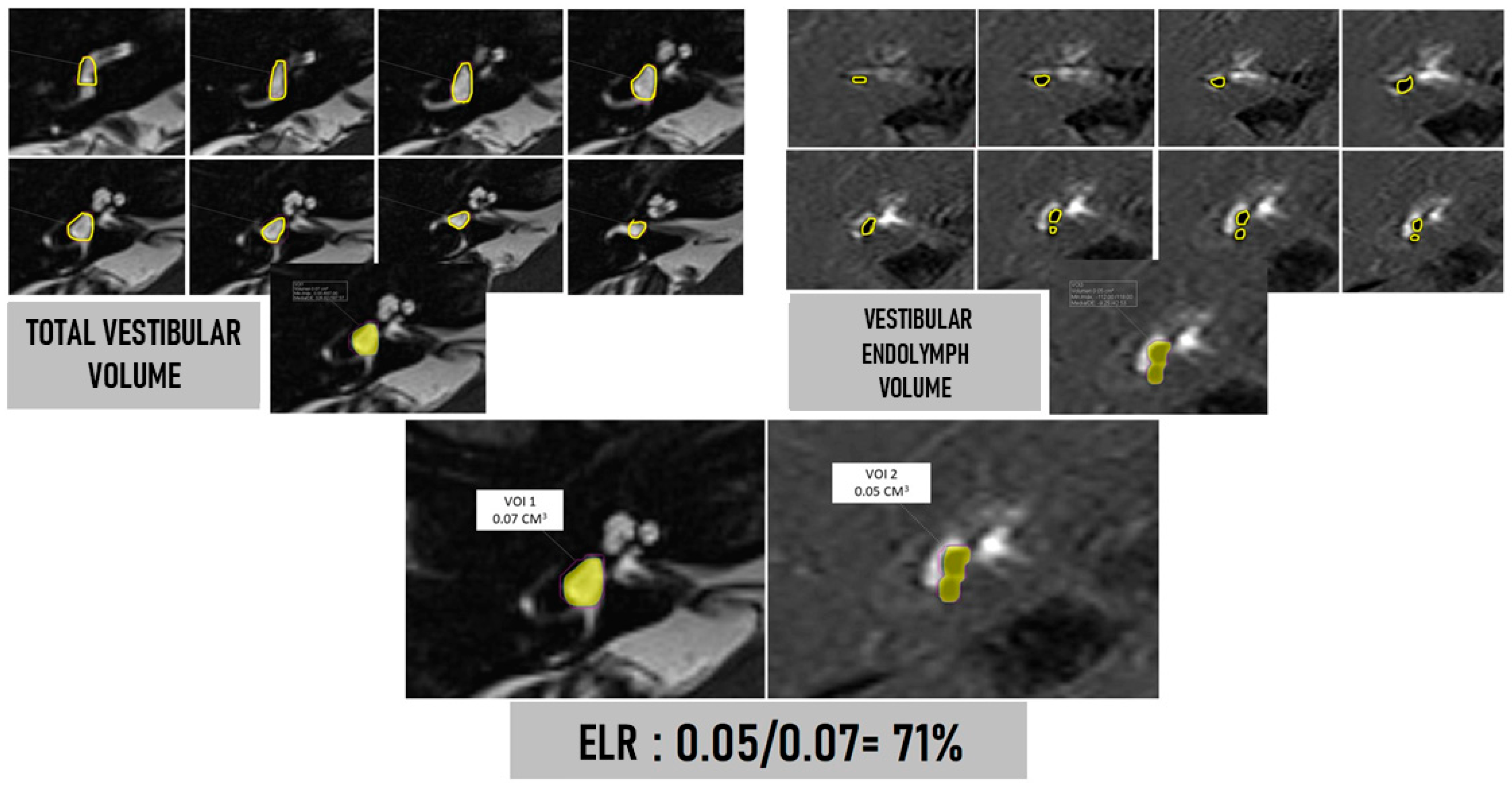 Magnetic Resonance Volumetric Quantification of Vestibular ...