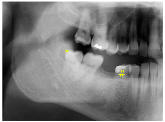 Pulp Revascularization in an Autotransplanted Mature Tooth ...