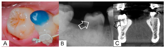 Pulp Revascularization in an Autotransplanted Mature Tooth ...