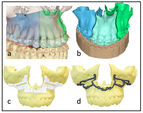 Accuracy of Patient-Specific Implants in Virtually Planned Segmental Le ...