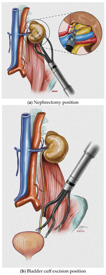 JCM | Free Full-Text | Retroperitoneal Single-Port Robot-Assisted Nephroureterectomy with ...