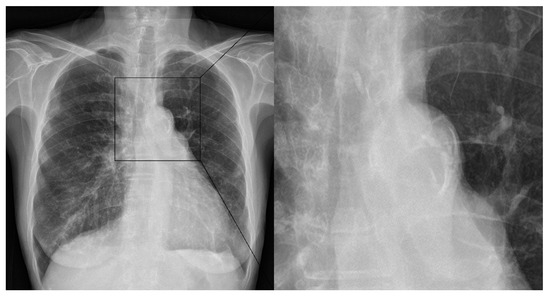 Impact on Endovascular Thrombectomy for Acute Ischemic Stroke of Aortic ...