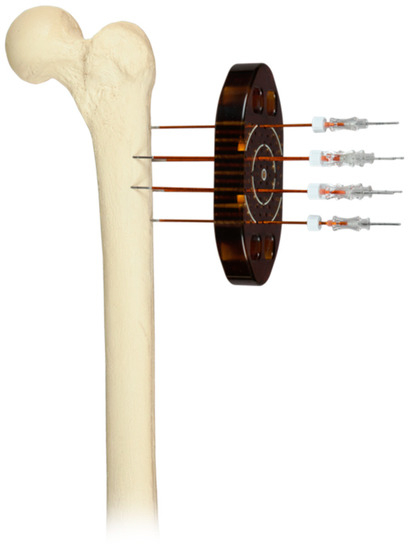 Electrochemotherapy in the Treatment of Bone Metastases: A Systematic ...