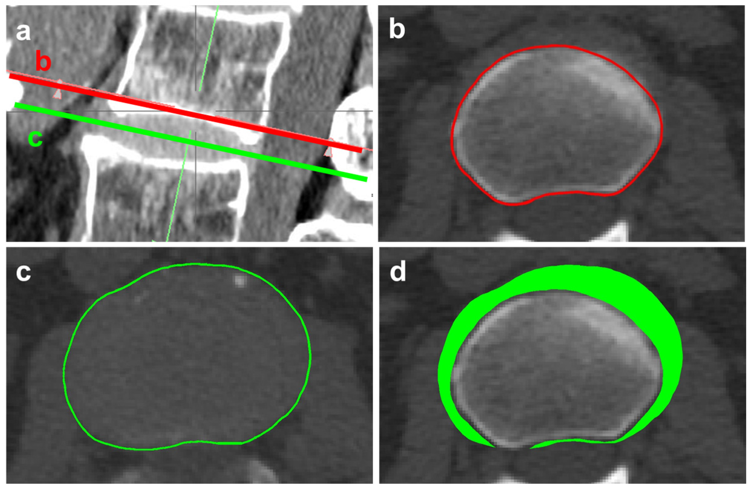 Quantitative Analysis of Lumbar Disc Bulging in Patients with Lumbar ...