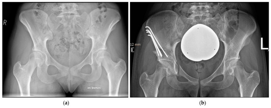 Periacetabular Osteotomy with a Modified Fixation Technique Using K ...