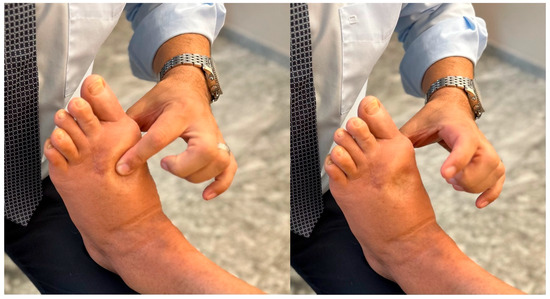 The Classic Three-Month Post-Operative Adaptation Phase in Foot and ...