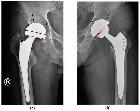 Deviation of Latitude Cut: A Simple Sign to Differentiate Total Hip ...