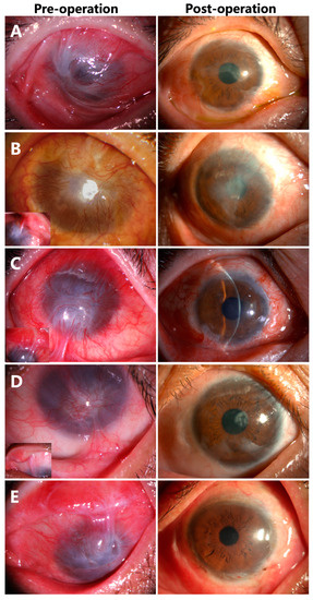 Conjunctival Limbal Autograft Combined with Amnion-Assisted ...