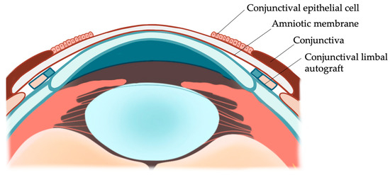 Conjunctival Limbal Autograft Combined with Amnion-Assisted ...