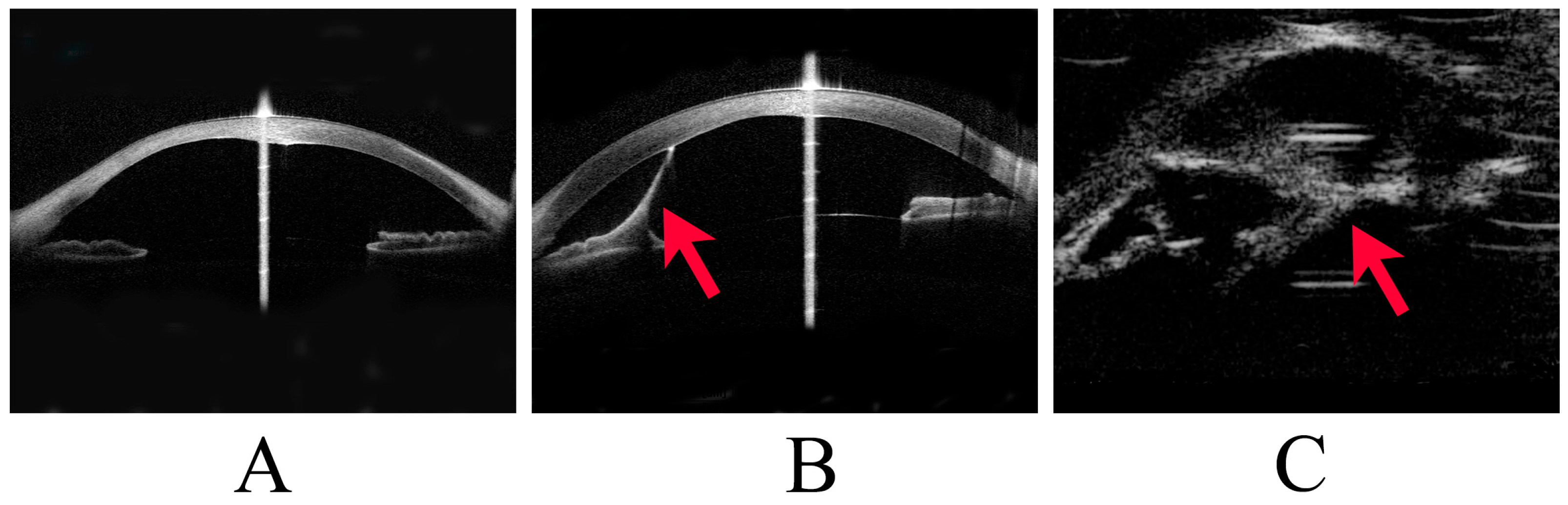 Risk and Prognostic Factors for Glaucoma Associated with Peters Anomaly