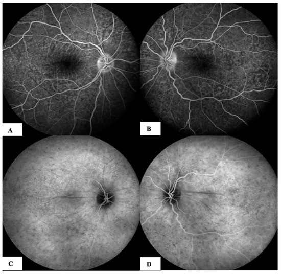 JCM | Free Full-Text | Vogt-Koyanagi-Harada Disease and COVID