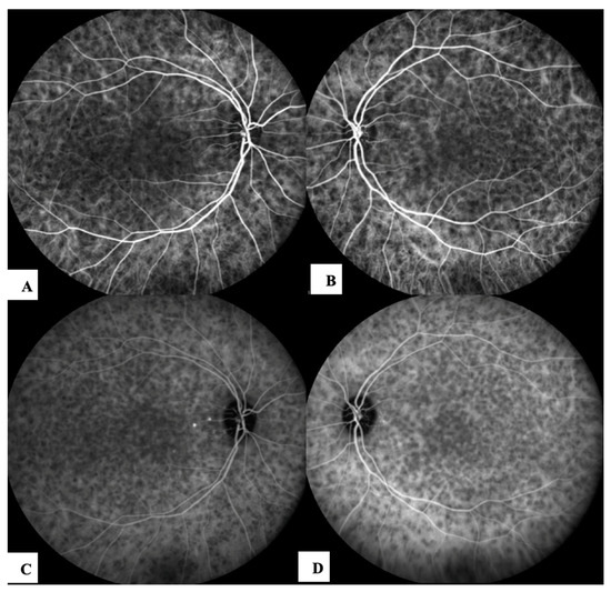 JCM | Free Full-Text | Vogt-Koyanagi-Harada Disease and COVID
