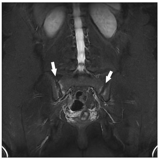 JCM | Free Full-Text | Diagnostic Value of an Additional Sequence (Large-Field Coronal Stir) in ...