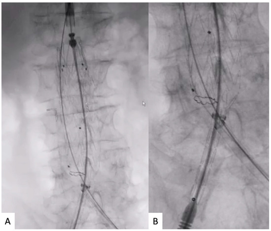 JCM | Free Full-Text | Outcome Analysis of Speed Gate Cannulation ...