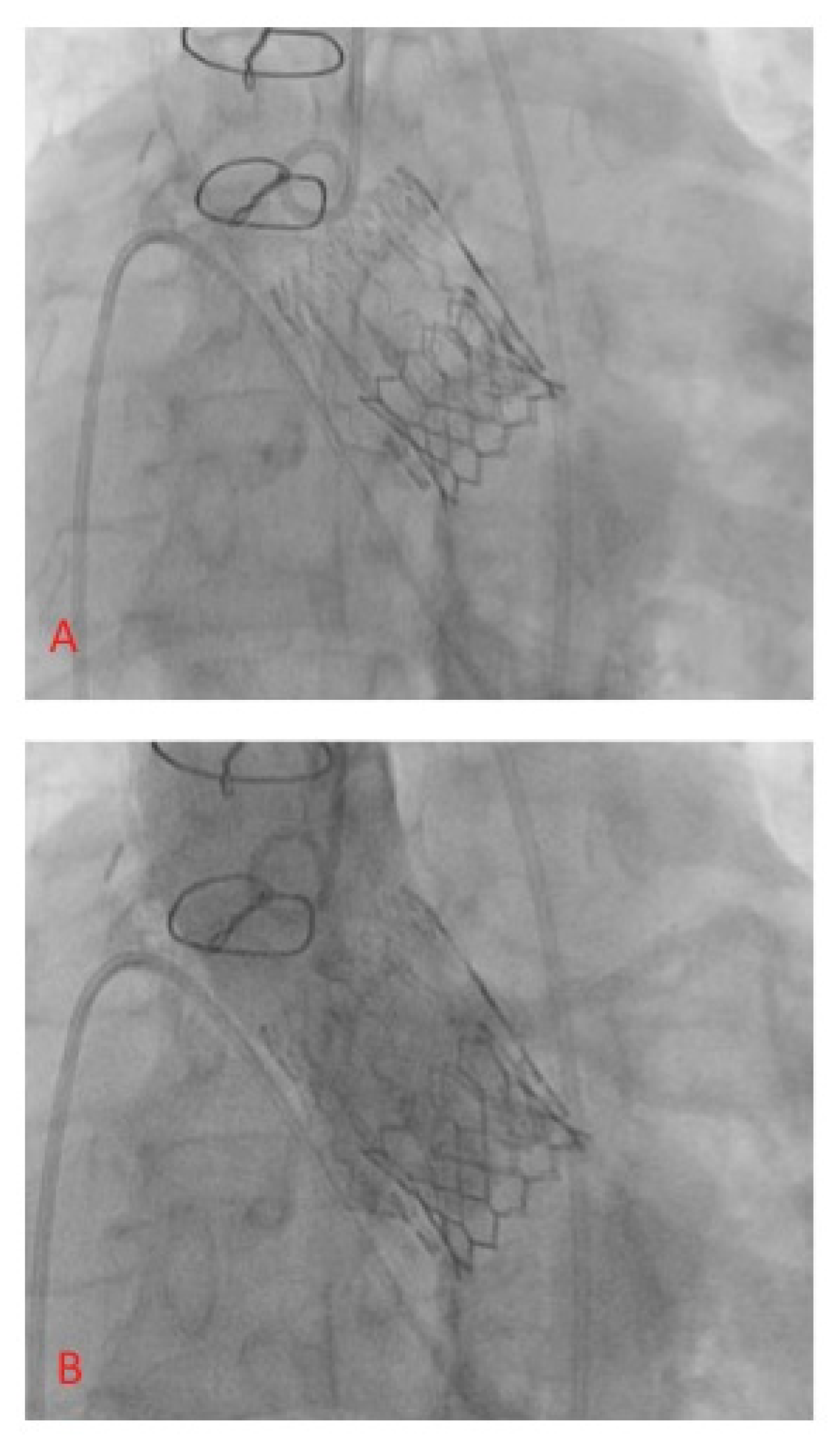 Transcatheter Aortic Valve Replacement in Degenerated Perceval ...