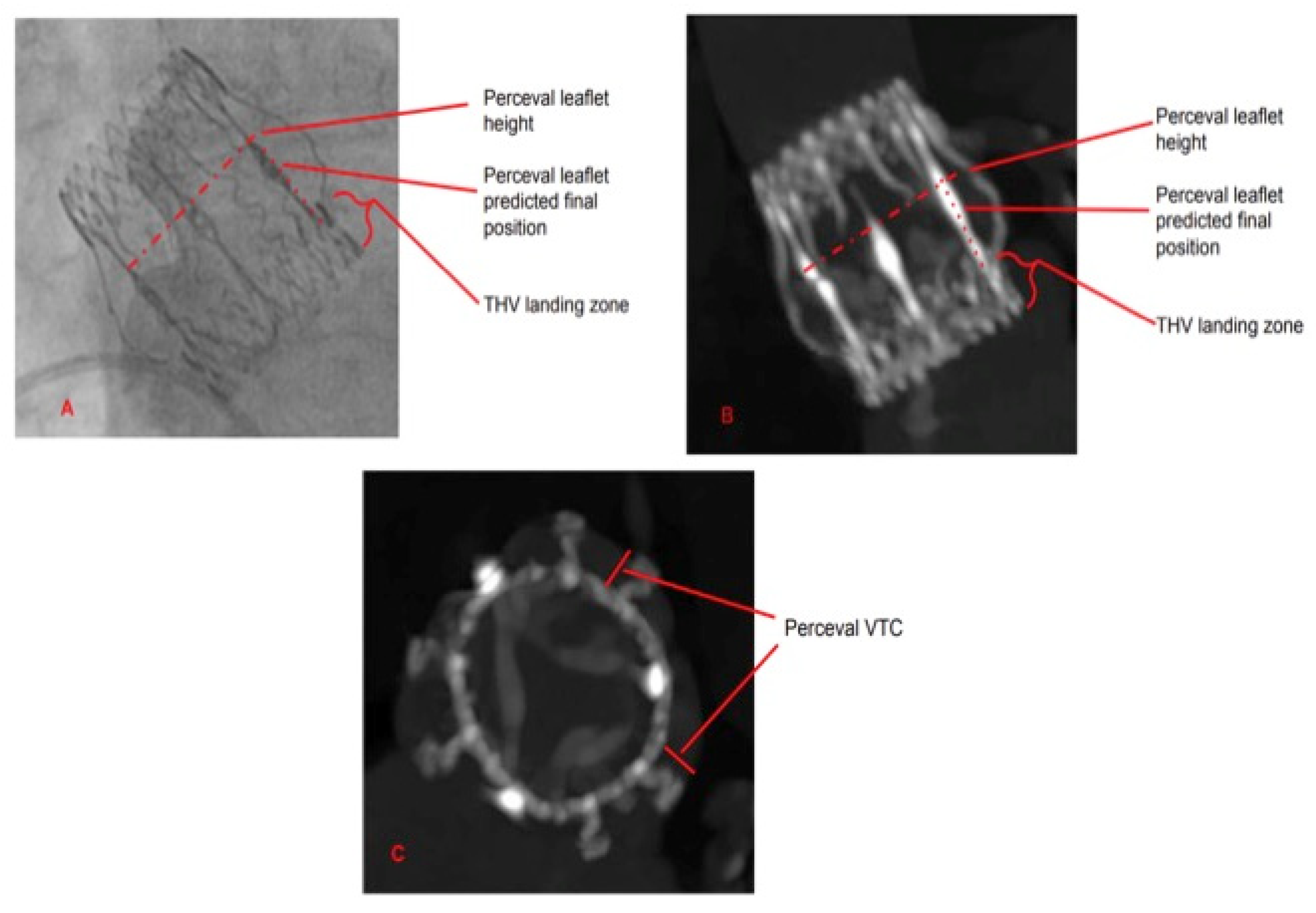 Transcatheter Aortic Valve Replacement in Degenerated Perceval ...