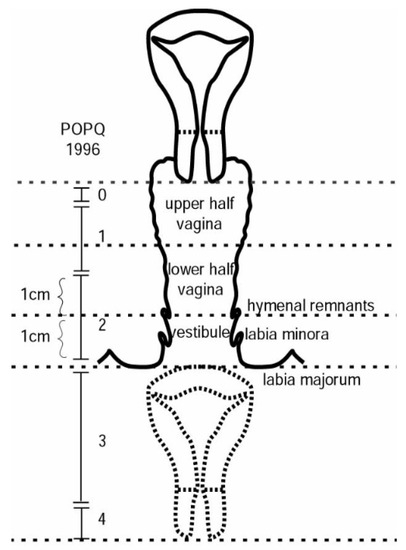 Sexuality in Postmenopausal Women with Genital Prolapse