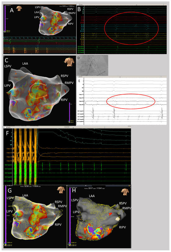 Left Atrial Posterior Wall Isolation with Pulsed Field Ablation in ...