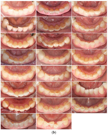 Erosive Tooth Wear in Subjects with Normal Occlusion: A Pioneering ...