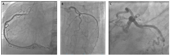 Left Atrial Appendage Occlusion on a Beating Heart during Minimally ...