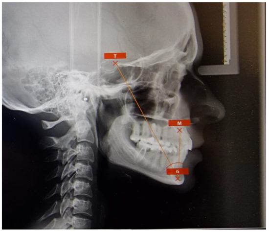 Comparison of Diagnostic Validity of Cephalometric Analyses of the ANB ...