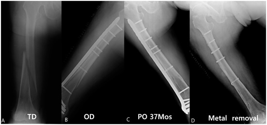 Risk Factors of Proximal Screw Breakage of Locking Plate (ZPLP®) after ...