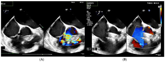 Transcatheter Closure of Perimembranous Ventricular Septal Defects ...