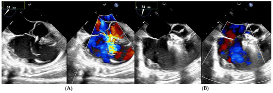 Transcatheter Closure of Perimembranous Ventricular Septal Defects ...