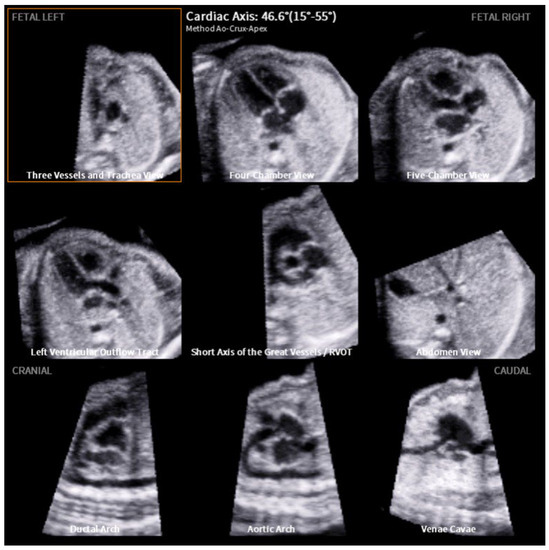 Semi-Automatic Measurement of Fetal Cardiac Axis in Fetuses with ...