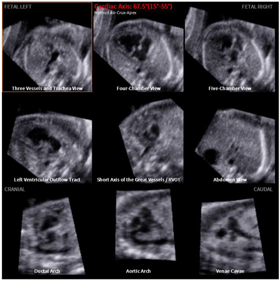 Semi-Automatic Measurement of Fetal Cardiac Axis in Fetuses with ...