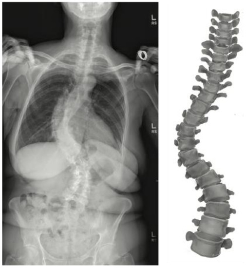 Advances and Evolving Challenges in Spinal Deformity Surgery