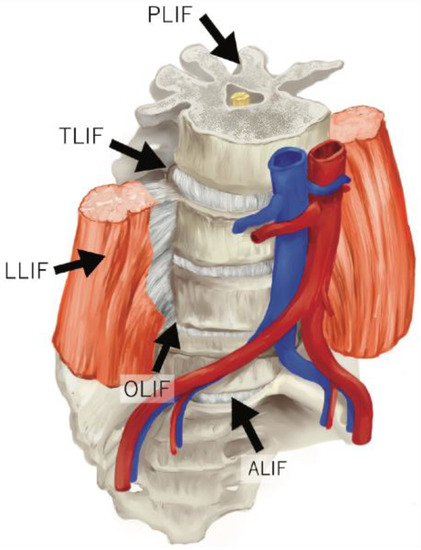 Advances and Evolving Challenges in Spinal Deformity Surgery