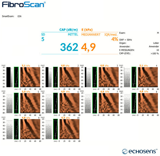 Glucocorticoid Replacement for Adrenal Insufficiency and the ...